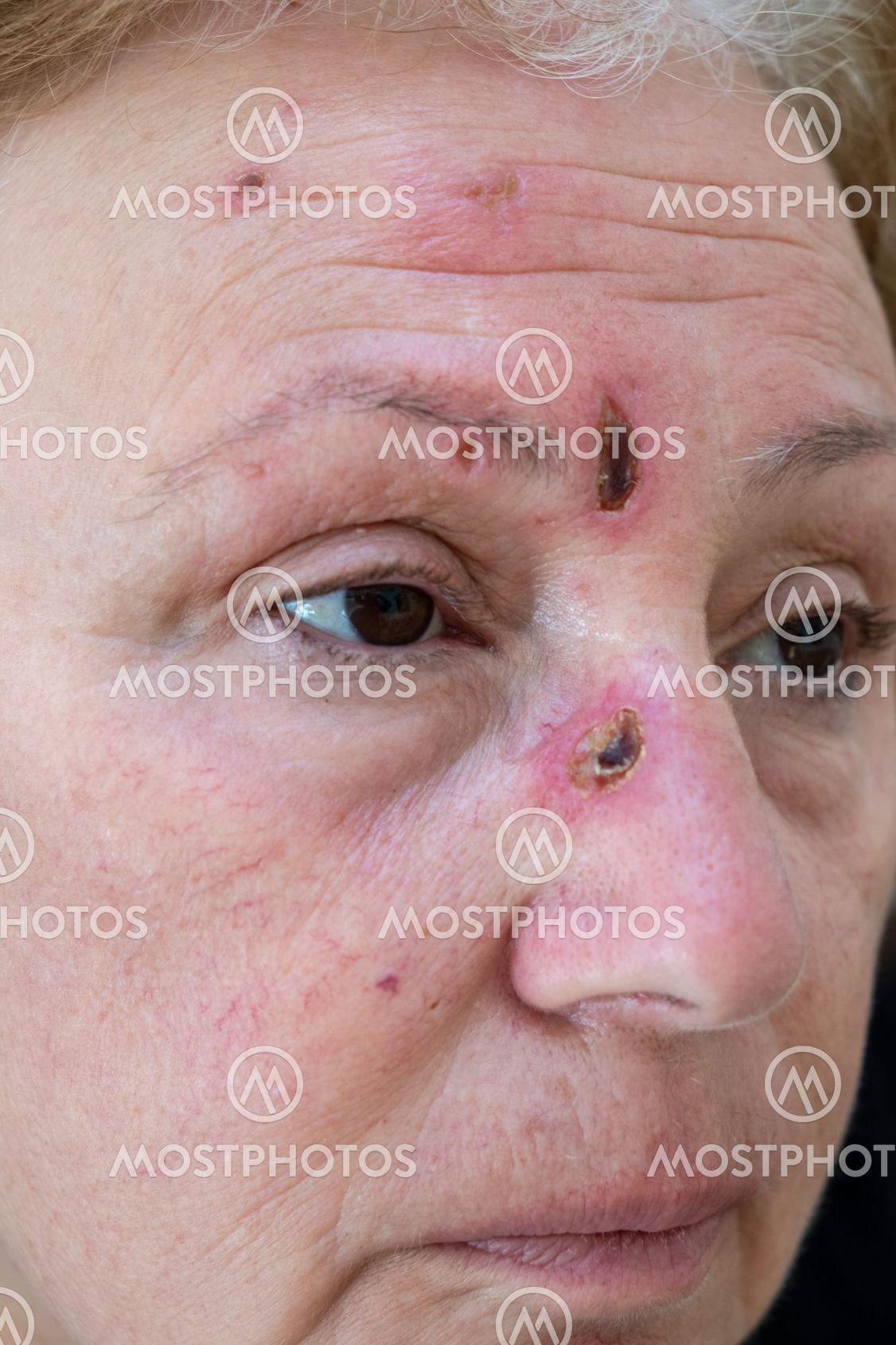 "diabetic wounds on face and..." by Mehmet BAYSAN - Mostphotos
