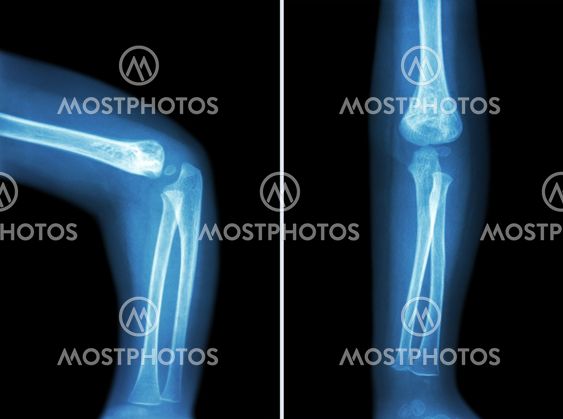 Normal Elbow X Ray In Children Film X Ray Of Child S Elbow ( Normal