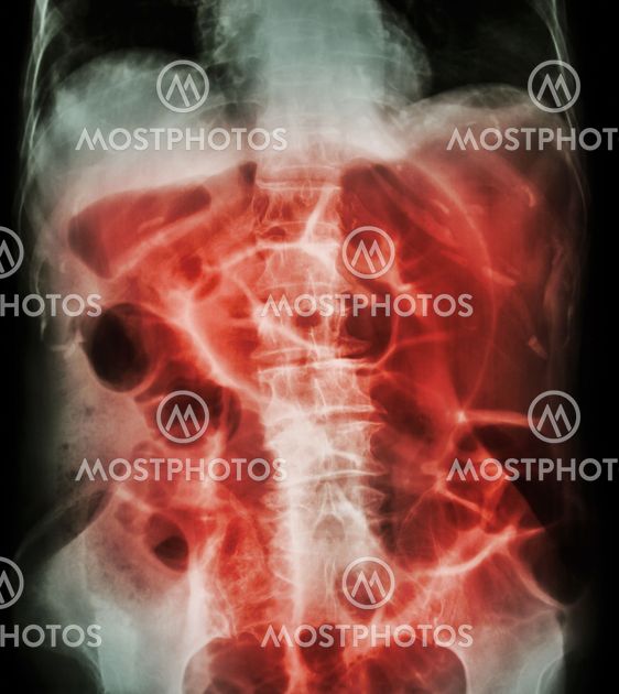 "Bowel Obstruction ( X-ray a..." by Puwadol Jaturawutthichai - Mostphotos