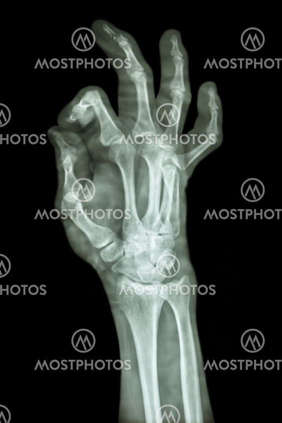 "comminute fracture distal p..." fra Puwadol Jaturawutthichai - Mostphotos