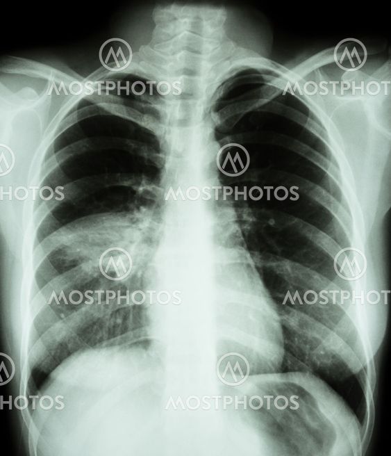 "Pneumonia ( film chest x-ra..." fra Puwadol Jaturawutthichai - Mostphotos