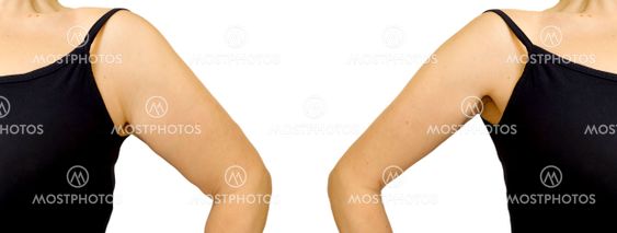 "woman fat hand before and a..." by Tetiana - Mostphotos