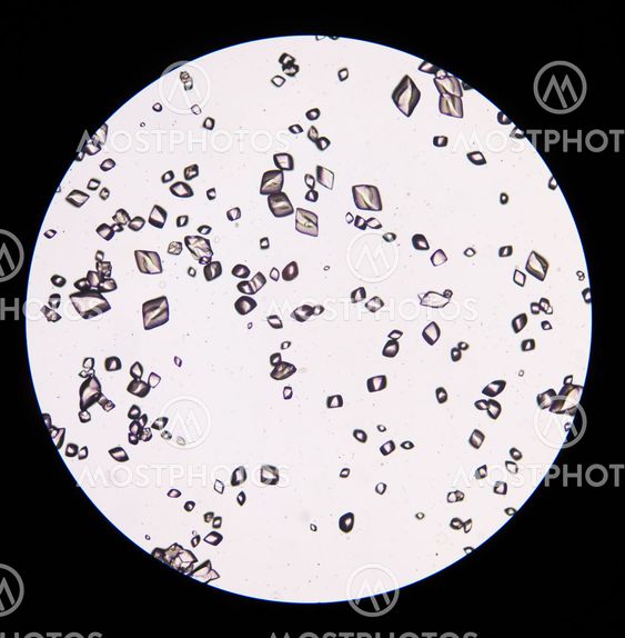 Uric Acid Crystal In Urine Av Chirawan Somsanuk Mostphotos